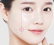 What is Dimpleplasty?