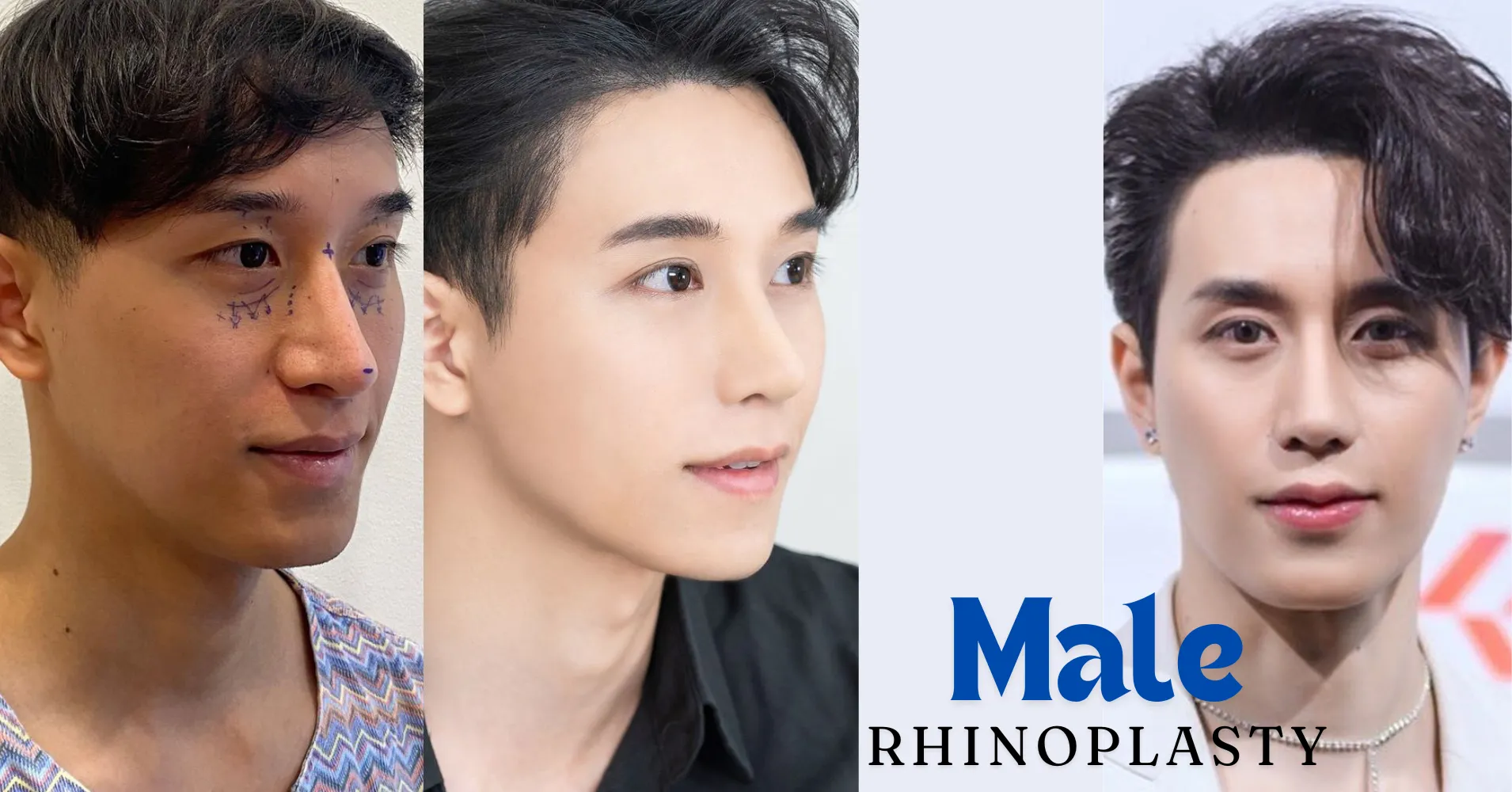 Male Rhinoplasty (Male Nose Job / Nose surgery for Men)